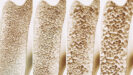 What Happens When You Break Your Spine? - Spine Doctor Singapore