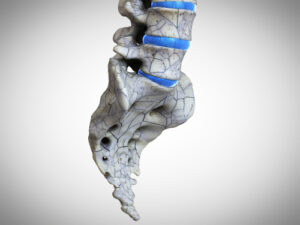 What Happens When You Break Your Spine? - Spine Doctor Singapore